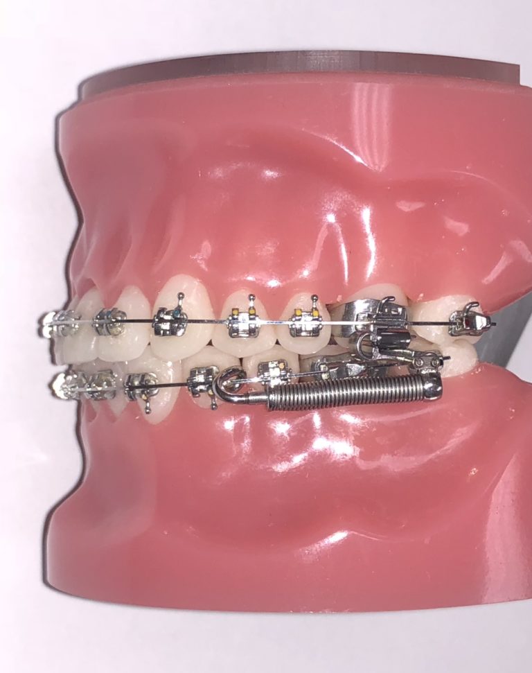 Appliance Instructions in Ashburn, VA | Ashburn Pediatric Dental Center